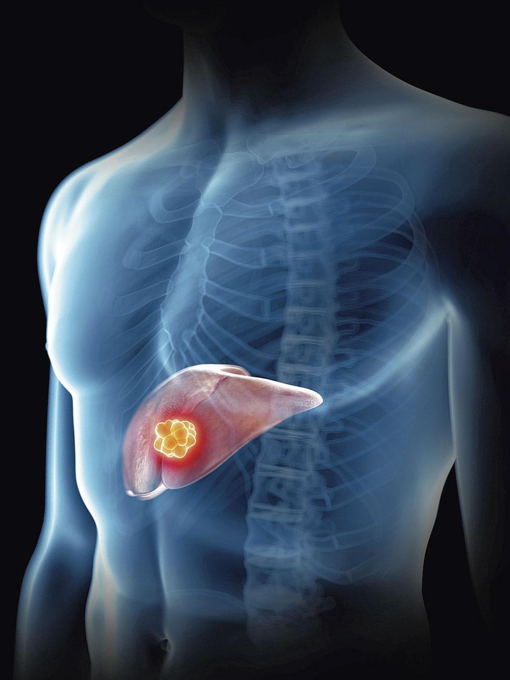 Prédire le cancer du foie - Trends-Tendances
