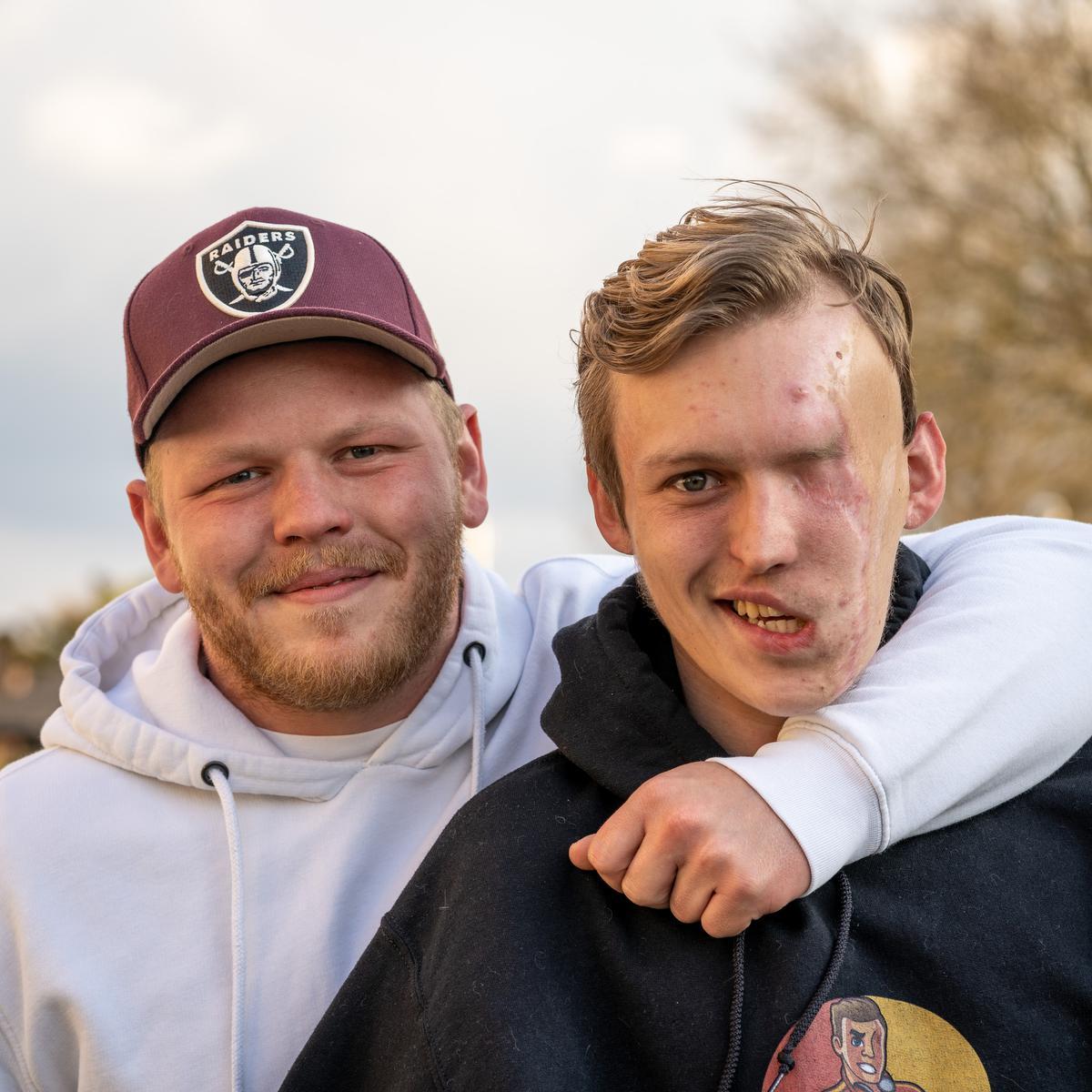 Stijn komt op voor verminkte broer Joeri na walgelijke reacties op ...