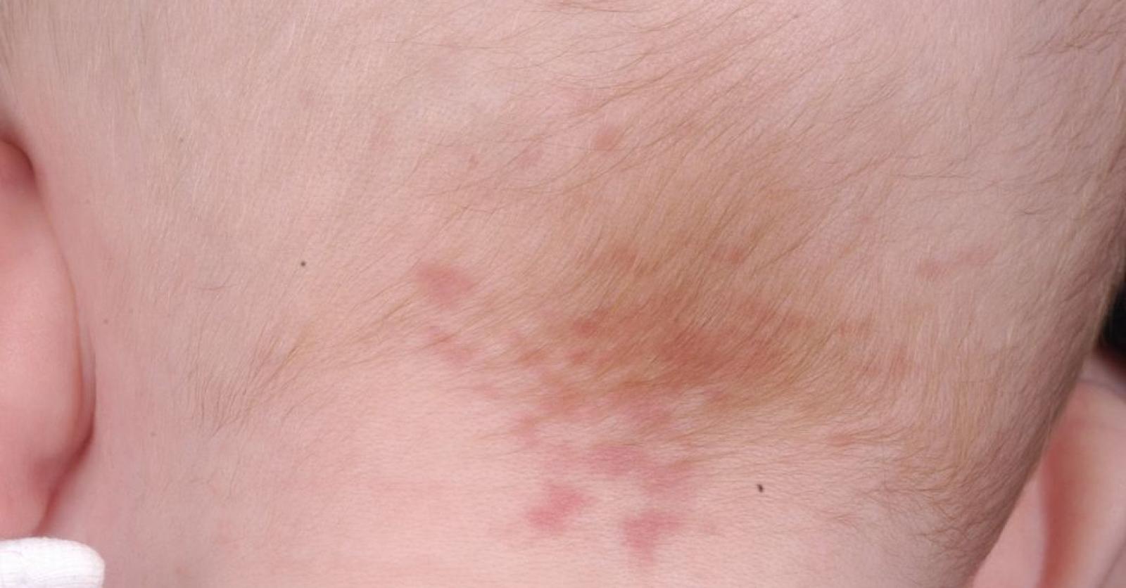 Ooievaarsbeet bij baby's: wat is het? - Libelle Mama