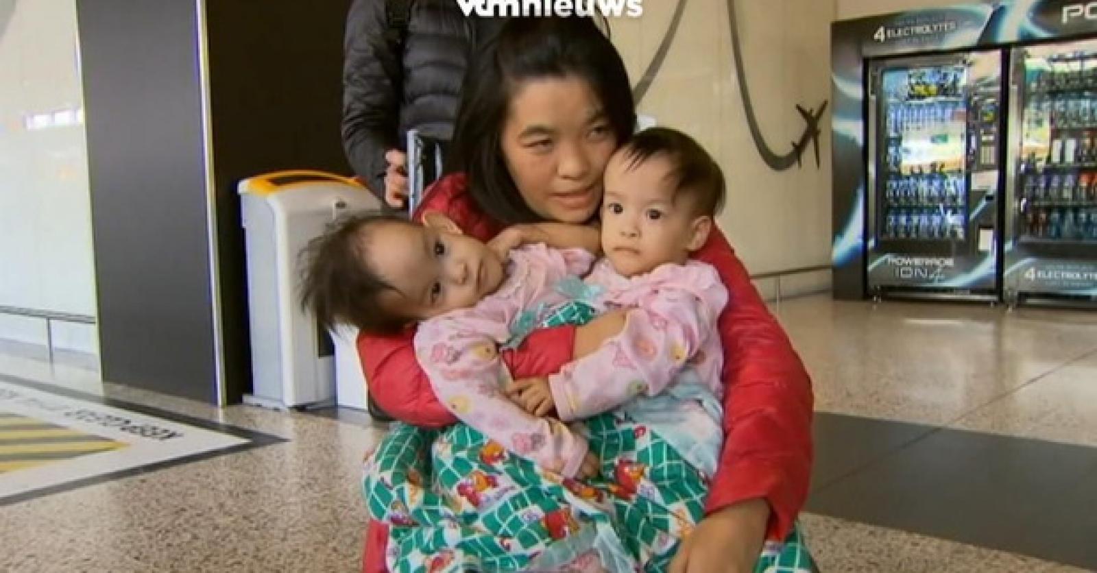 Deze siamese tweeling wordt gescheiden