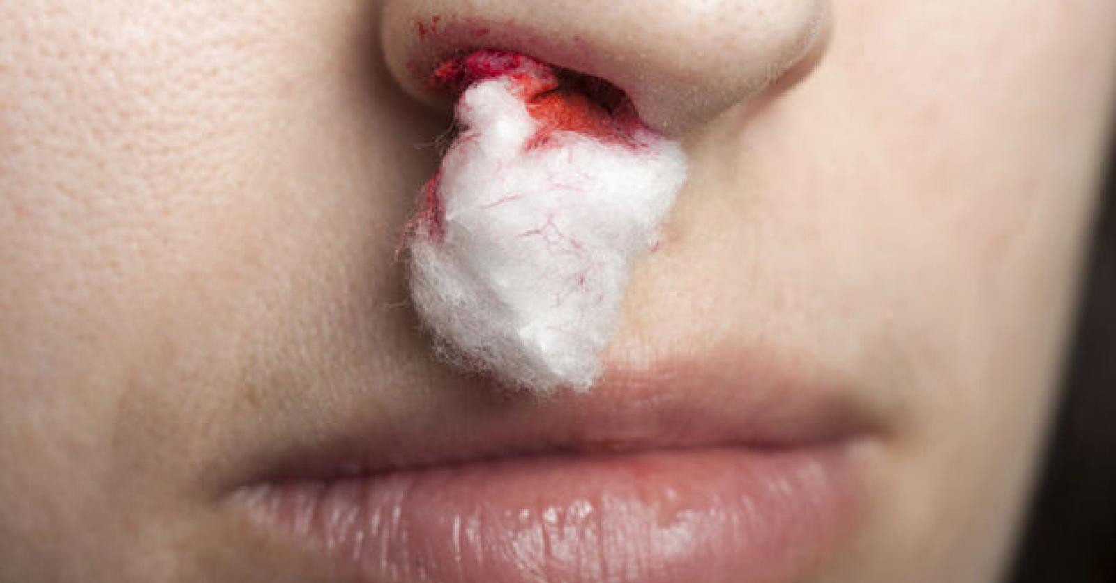 Hoe stelp je een bloedneus?