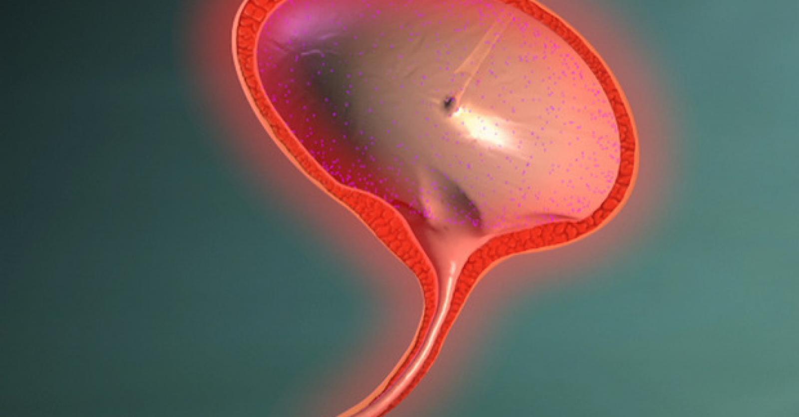 Une cystite - Plus Magazine