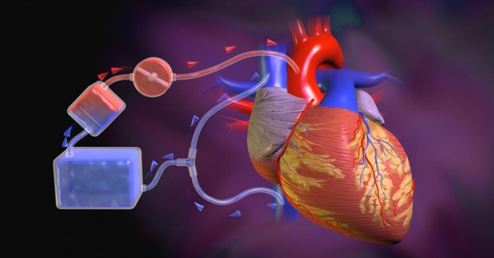 Le pontage coronarien - Plus Magazine