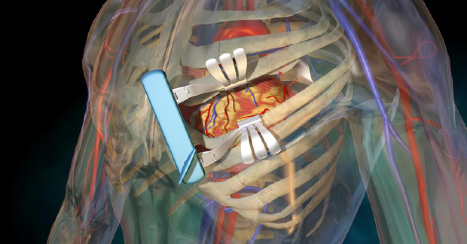 OPCAB hartoperatie - Plus Magazine