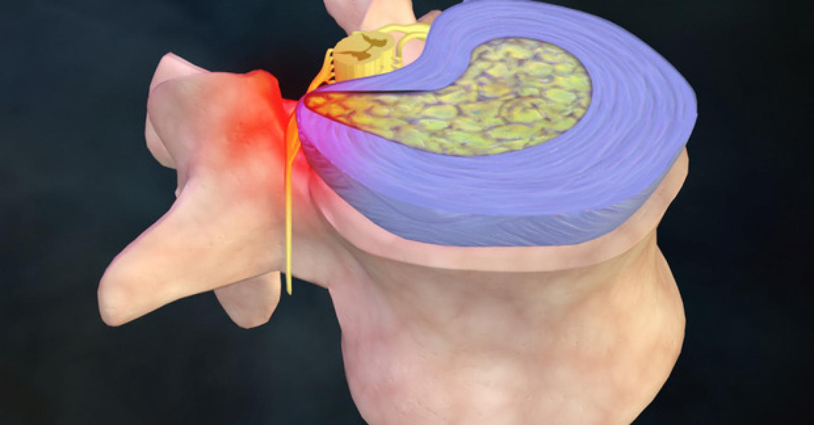 Gescheurde tussenwervelschijf of discushernia - Plus Magazine