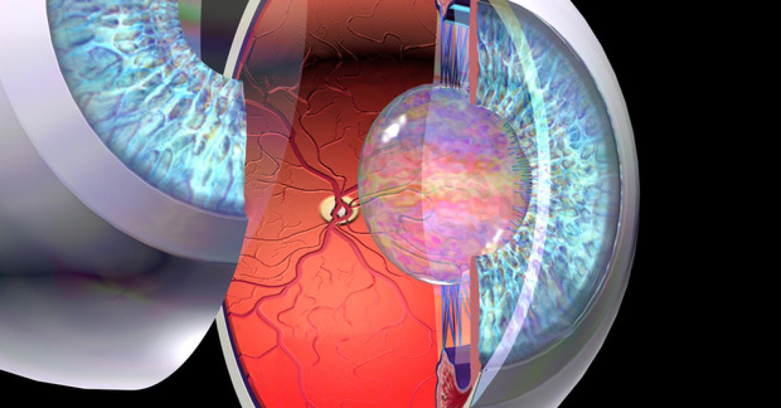 Cataract of staar - Plus Magazine