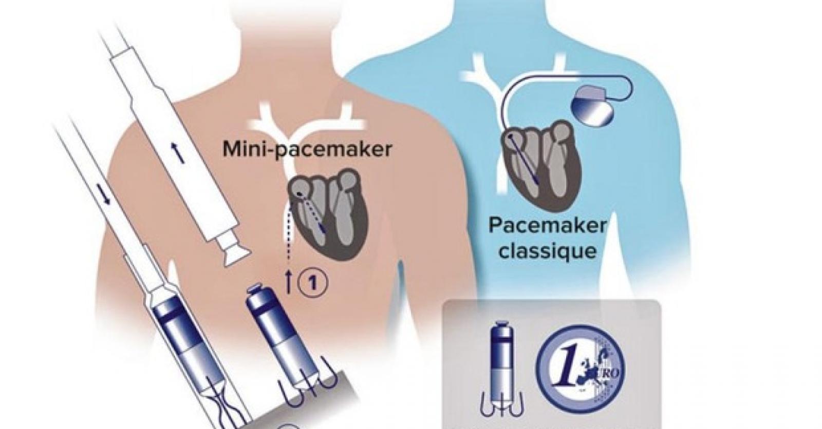 Le plus petit pacemaker du monde - Plus Magazine