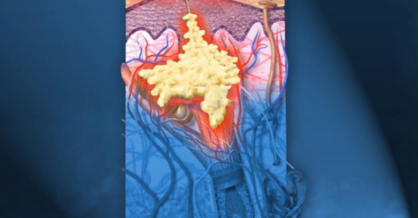 Acne - Plus Magazine