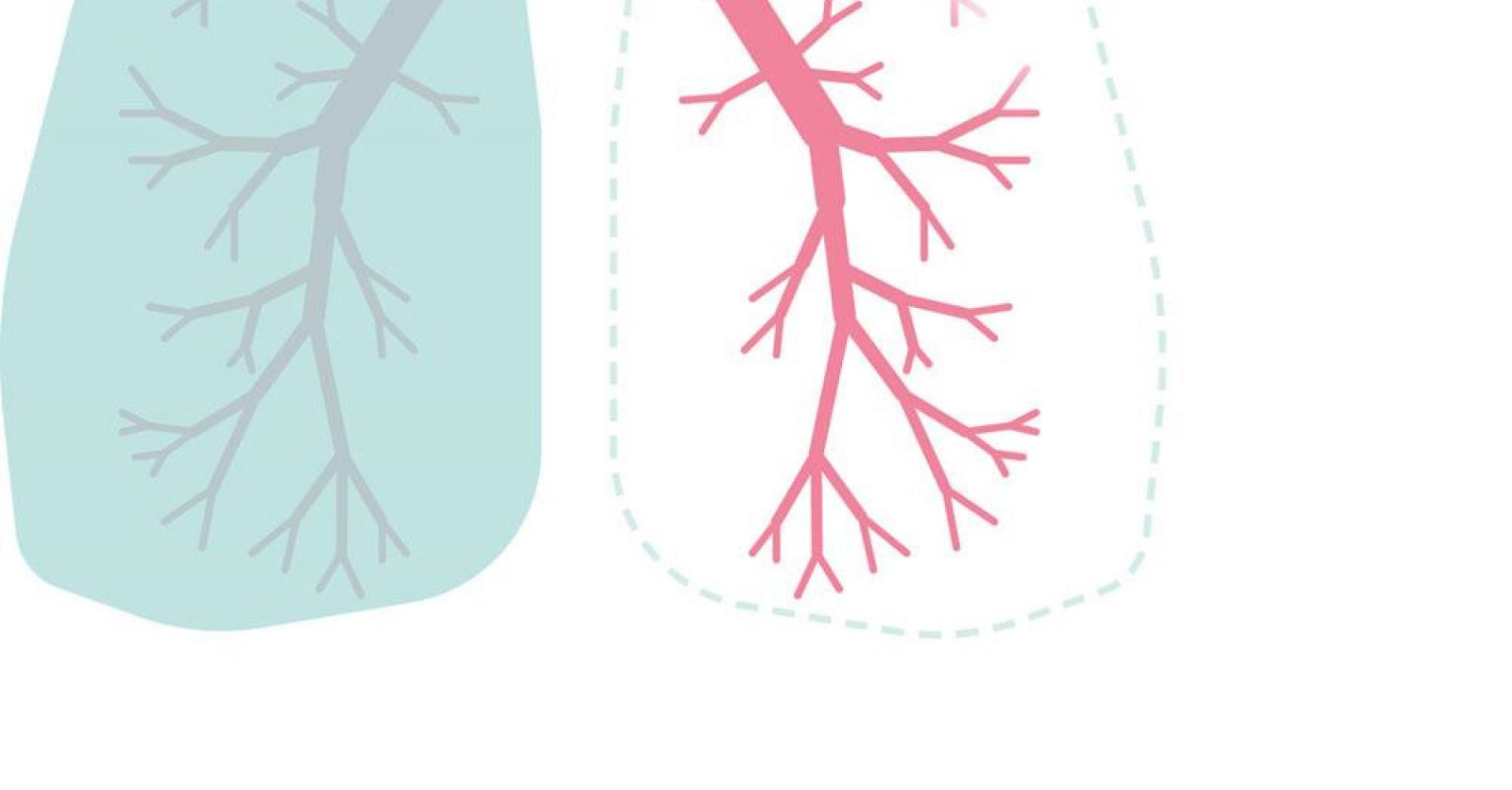 Longemfyseem: weer ademruimte dankzij longkleppen - Plus Magazine