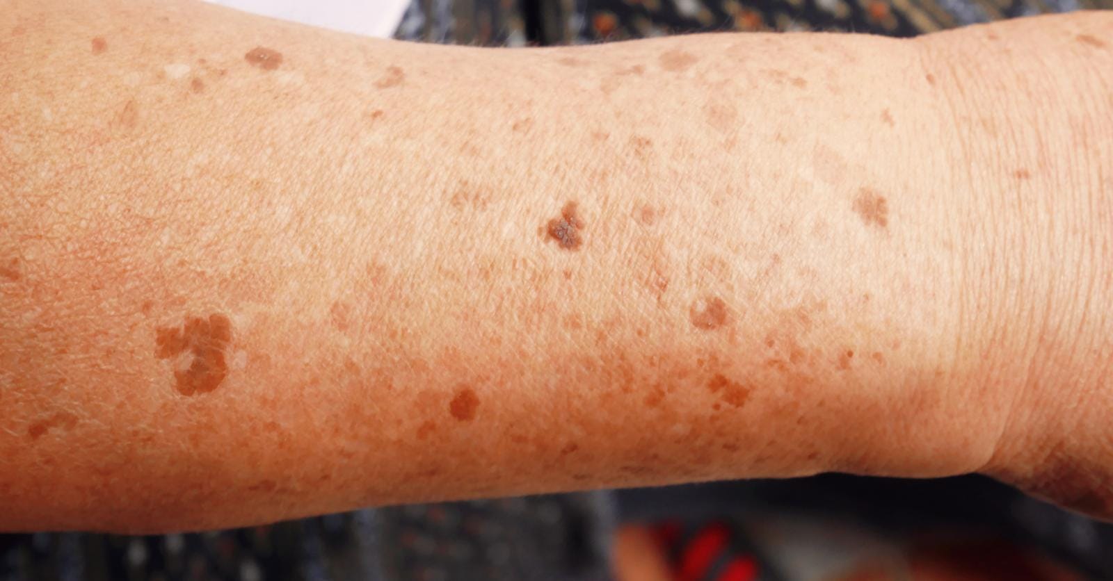 Pourquoi des taches brunes apparaissent sur la peau avec l’âge?