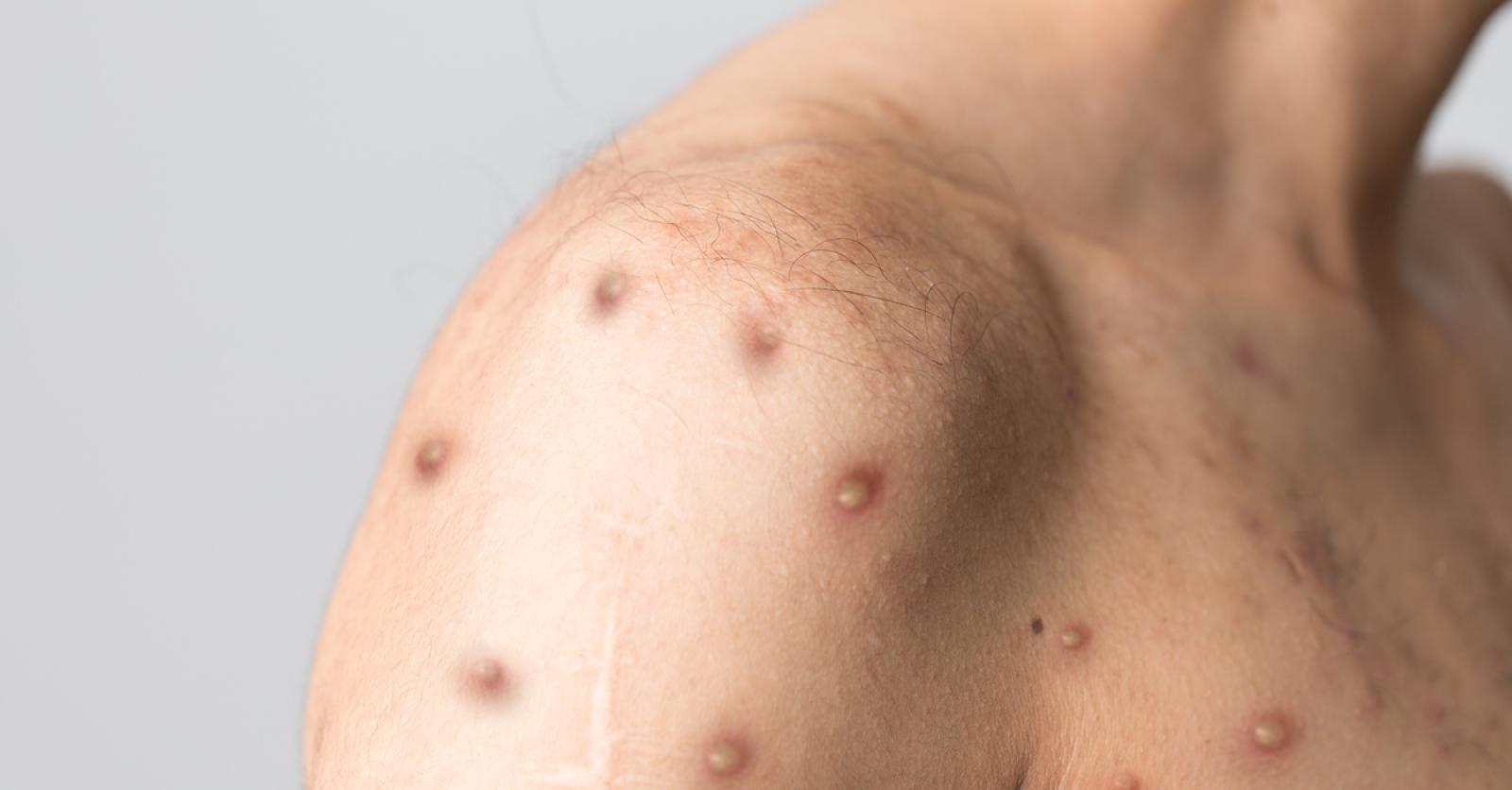 WHO lanceert nieuwe benaming voor apenpokken