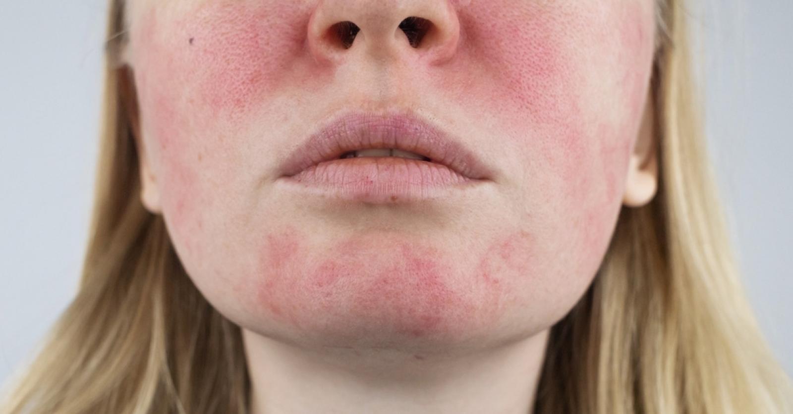 Qu’est-ce que la rosacée et comment la traiter?