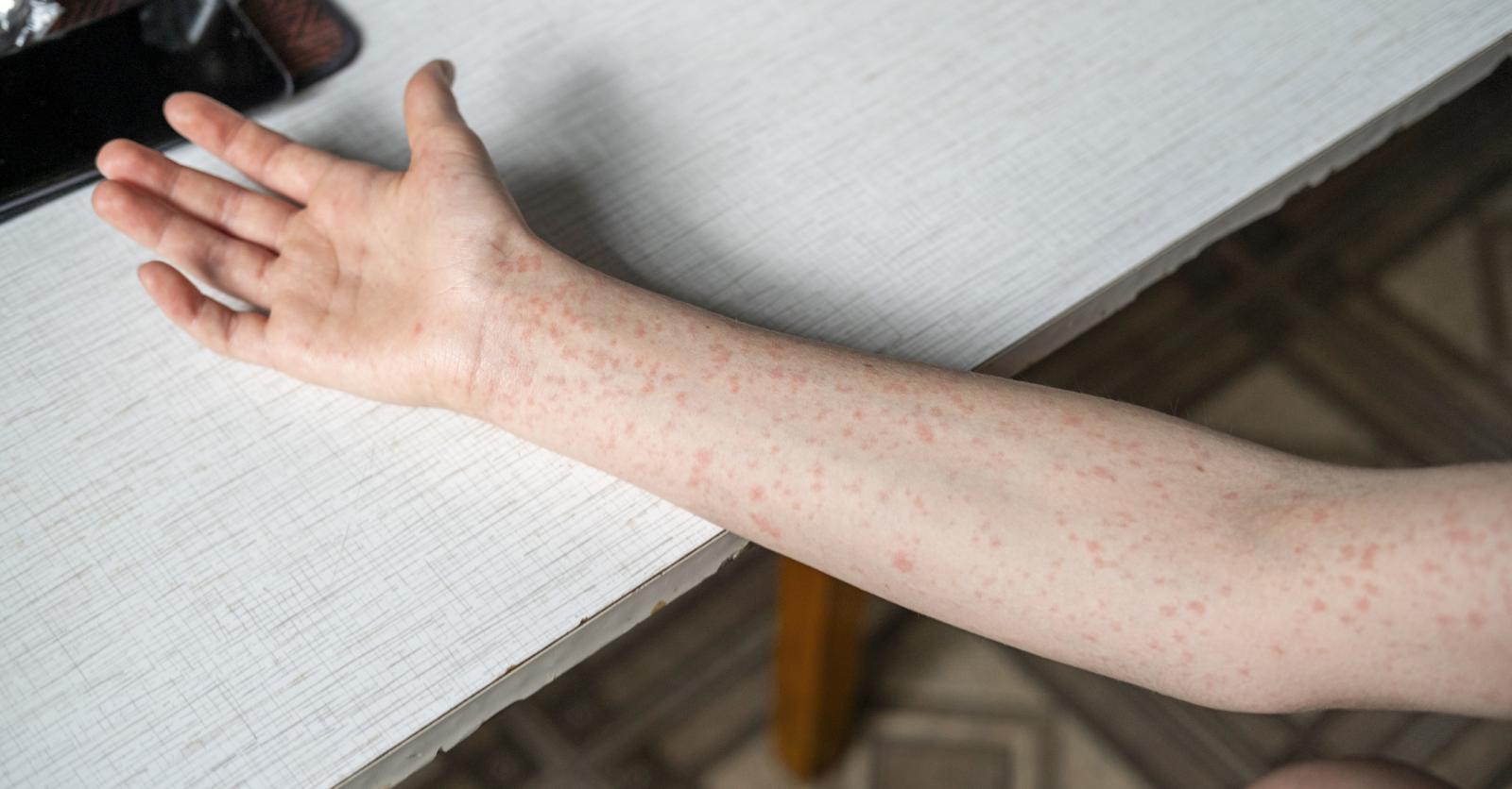 Wat als je rubella of rodehond krijgt tijdens je zwangerschap ...