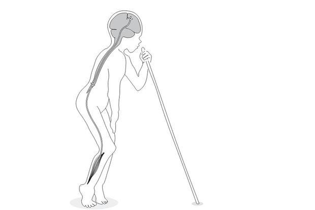 RDC: Le konzo, maladie invalidante, a frappé plus de 200 personnes en ...