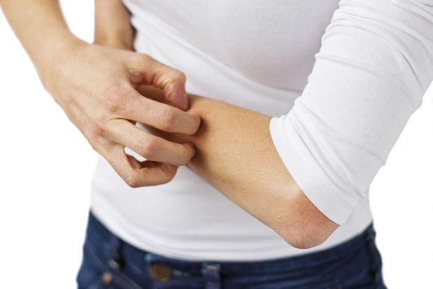 Découverte d'un traitement efficace à 90% contre le psoriasis