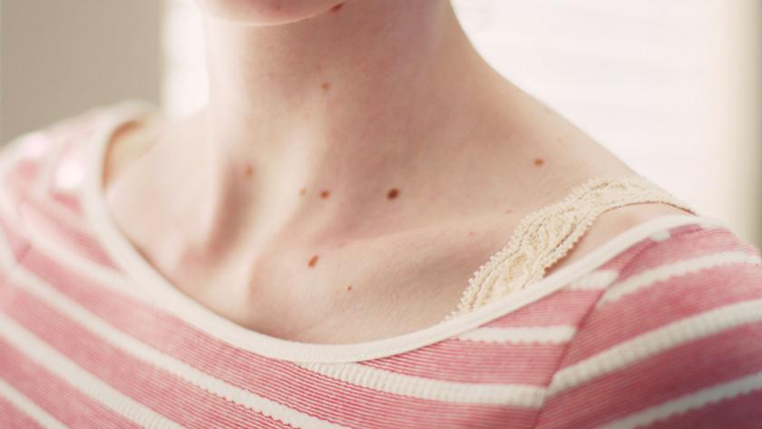 Moedervlek of melanoom: waar moet je op letten? - Libelle